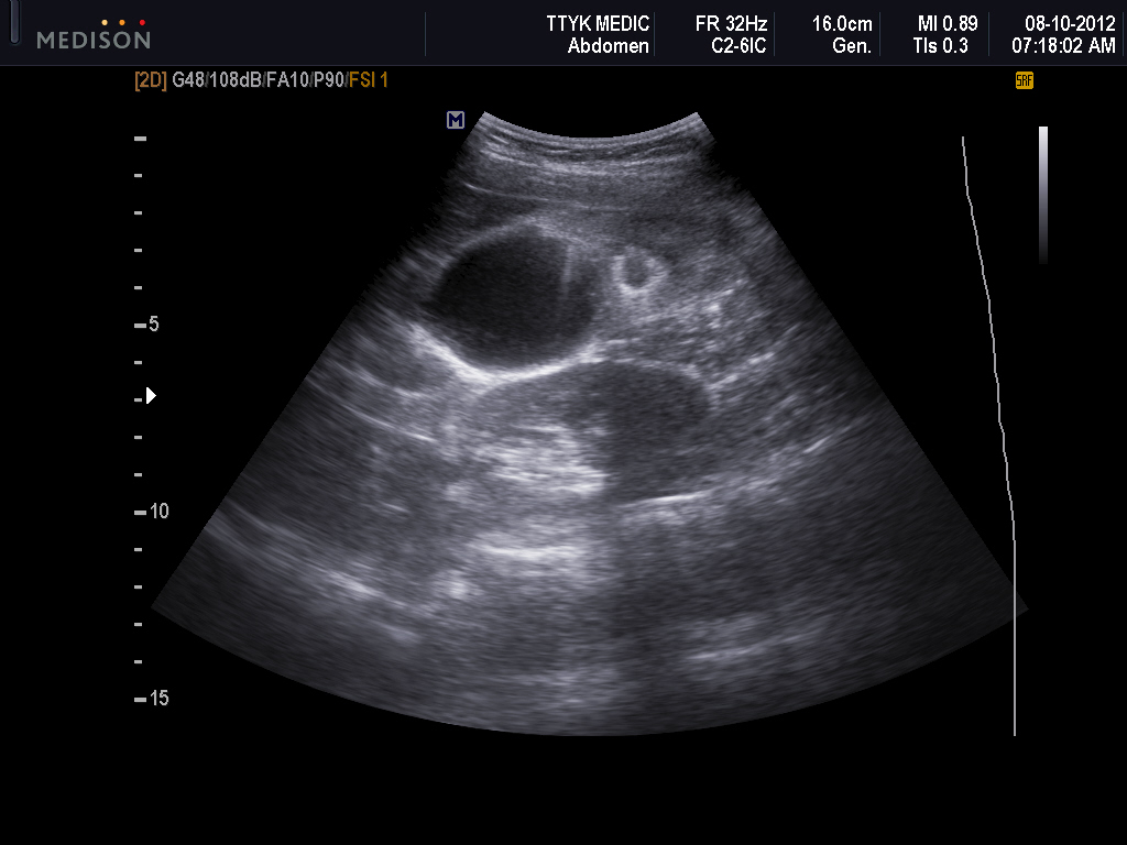 VIETNAMESE MEDIC ULTRASOUND: CASE 144: ABNORMAL GALL BLADDER, Dr PHAN ...
