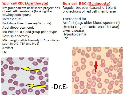 مدونة معملي للتحاليل الطبية والاختبارات المعمليه: Acanthocytes تشوهات ...