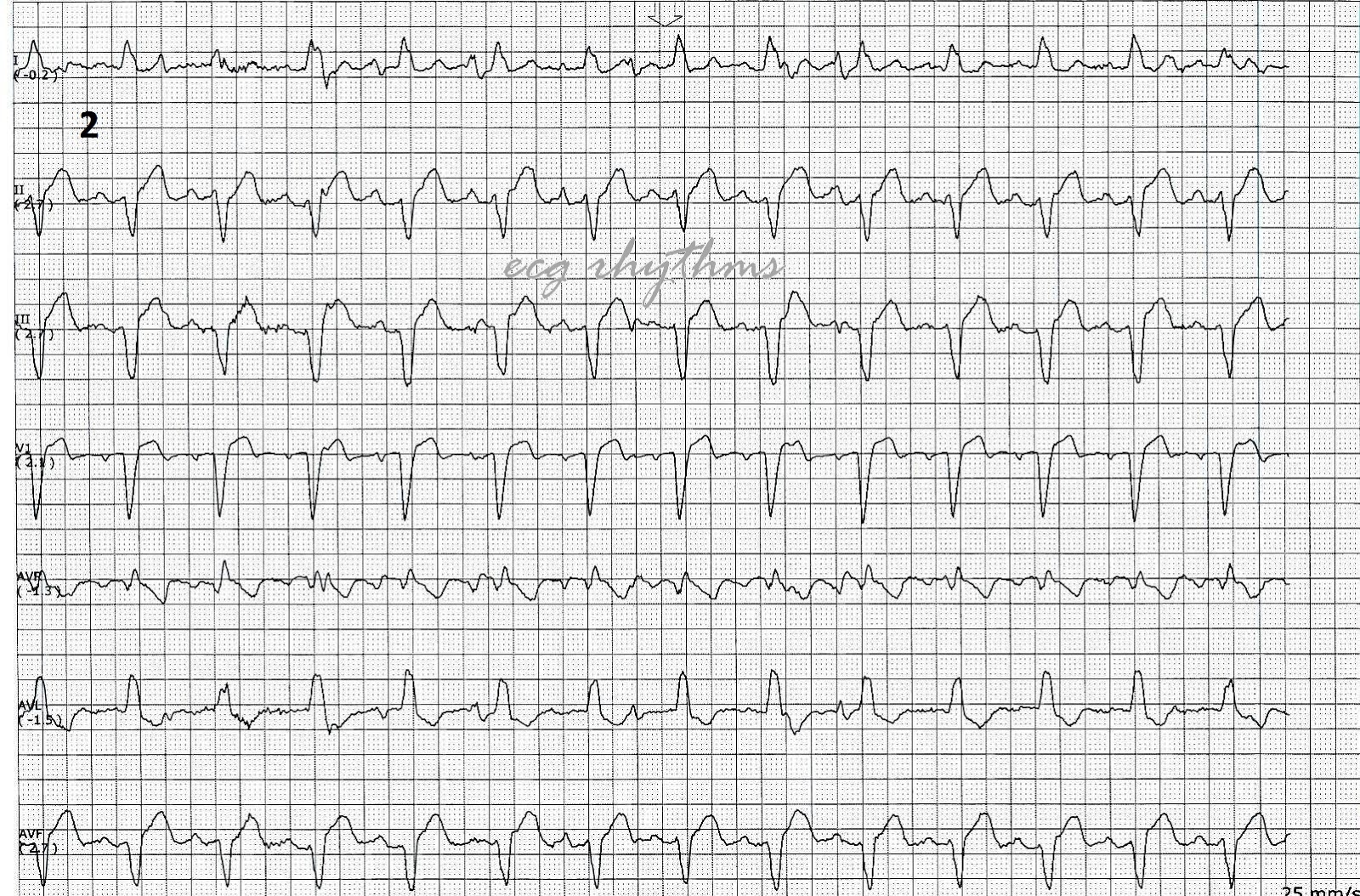 ECG Rhythms: Acceleration dependent LBBB