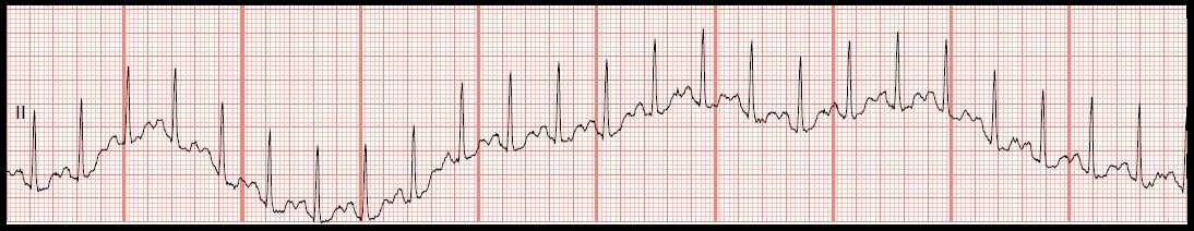 ECG Rhythm Strip Quiz 105