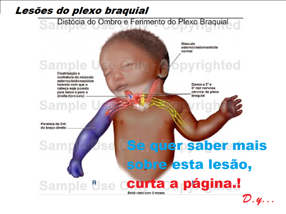 Lesão de Plexo Braquial