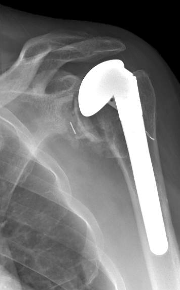 Shoulder and Elbow Surgery: Revision of failed anatomic total shoulder ...