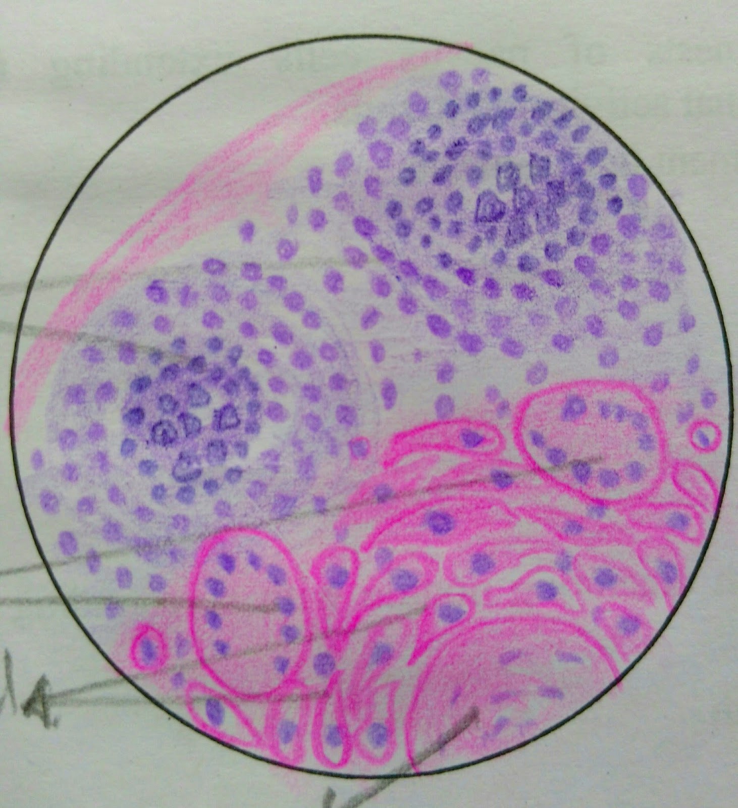 Histopathology Drawings: TB of lymph node