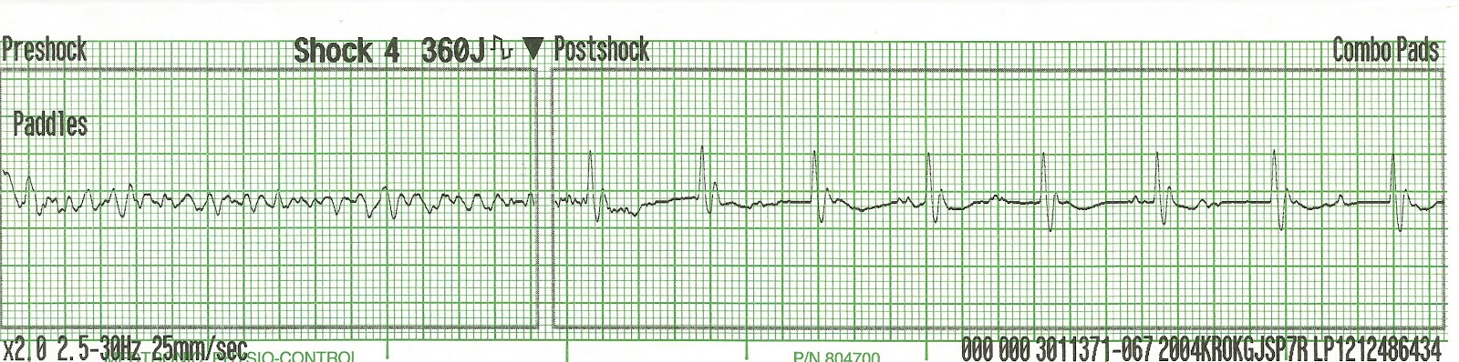 Code Blue: Refractory Ventricular Fibrillation