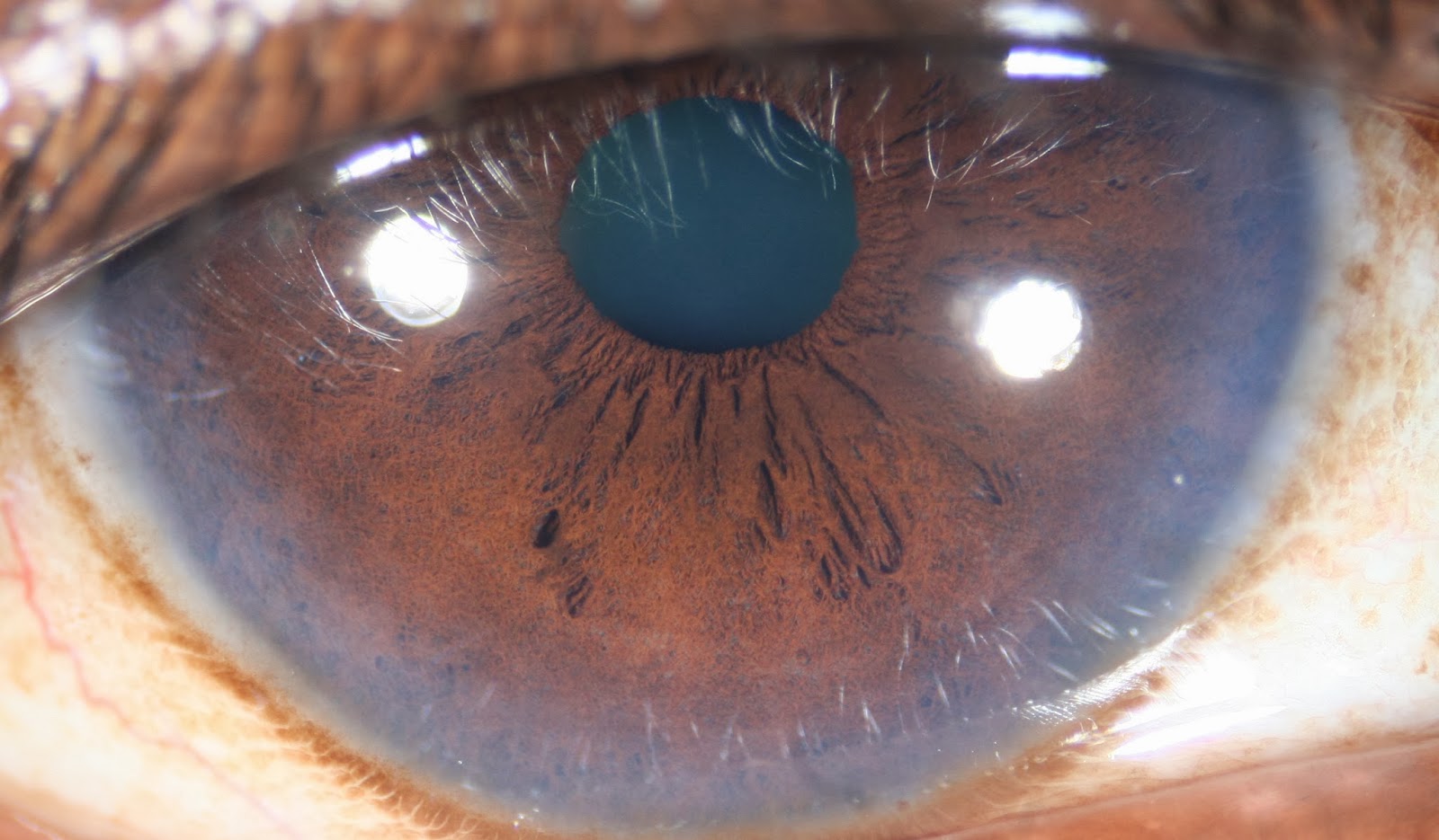 Modern & Multidimensional Iridology: Atrophy, Space Deficiency ...