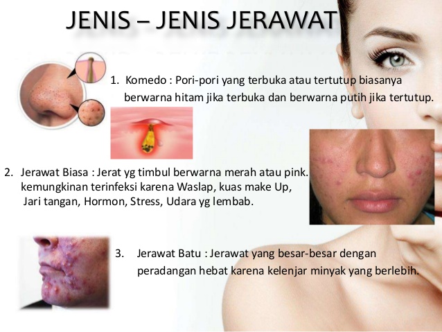 Berbagai Macam Jenis Jerawat - Cara Mengatasi Jerawat