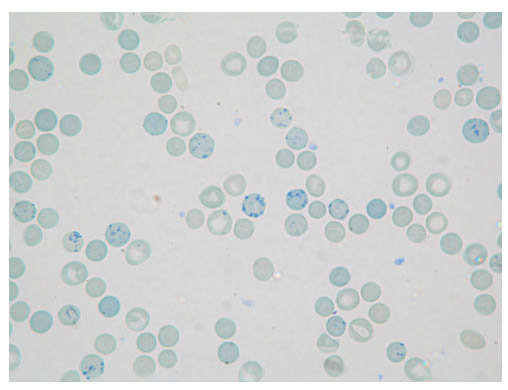 HEMATOLOGIA: PRACTICA 2: TINCION DE AZUL DE CRESIL BRILLANTE PARA ...