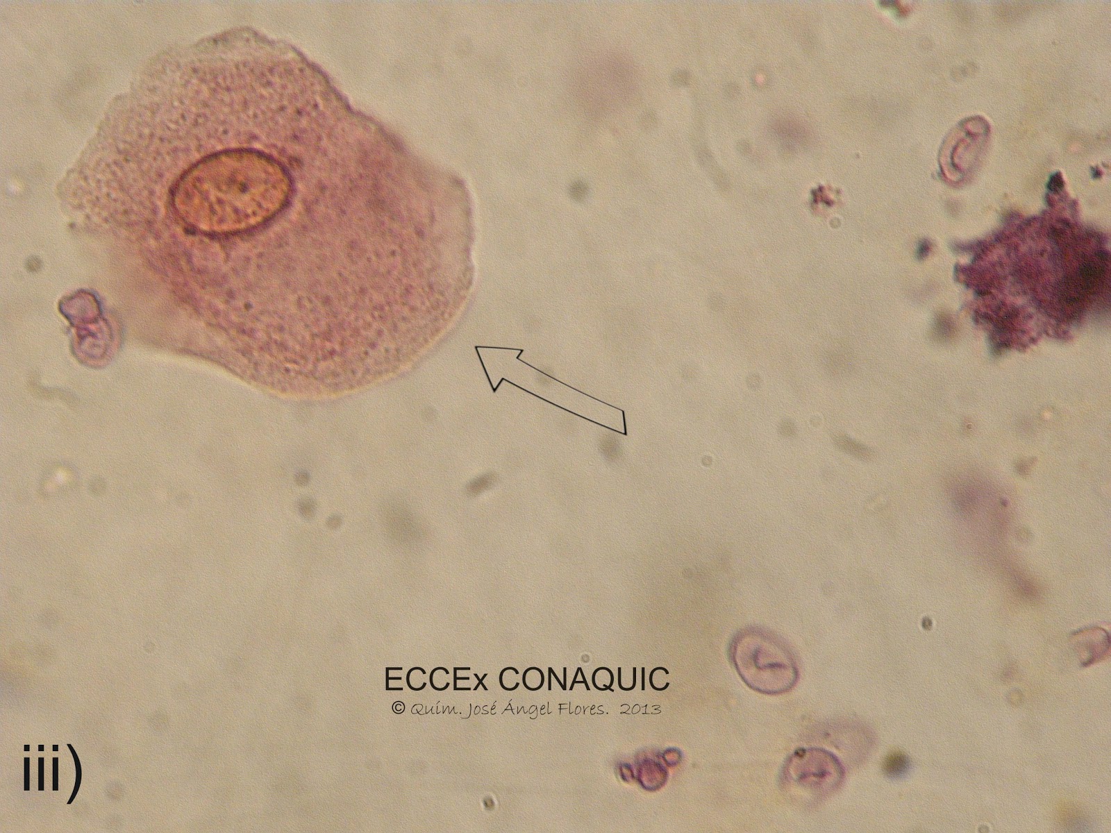 Caso UR- febrero-13 (Enfoque: inflamación)