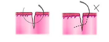 Every Details about Oral Surgery: How to suture wound tissue?? - Ten ...