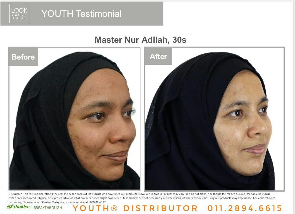 Cara Menghilangkan Jerawat Batu hinggap di Muka dengan Berkesan dan ...