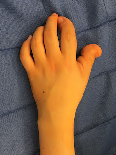 Surgery for Macrodactyly | Congenital Hand and Arm Differences ...