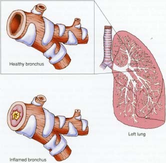 Bronchitis : Symptome Ursachen und Abhilfen