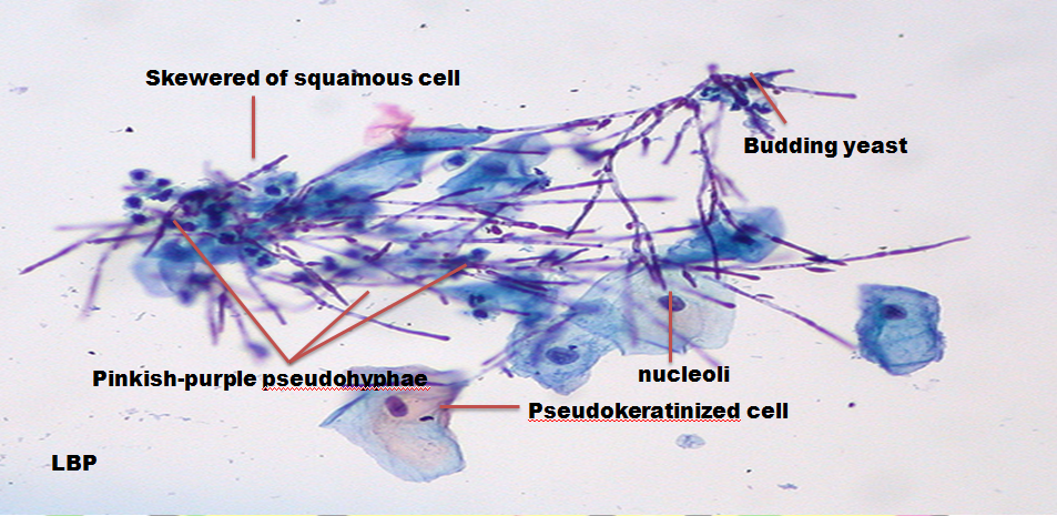 Infections in PAP SMEAR: CELLULAR CHANGES ASSOCIATED WITH CANDIDA SPP