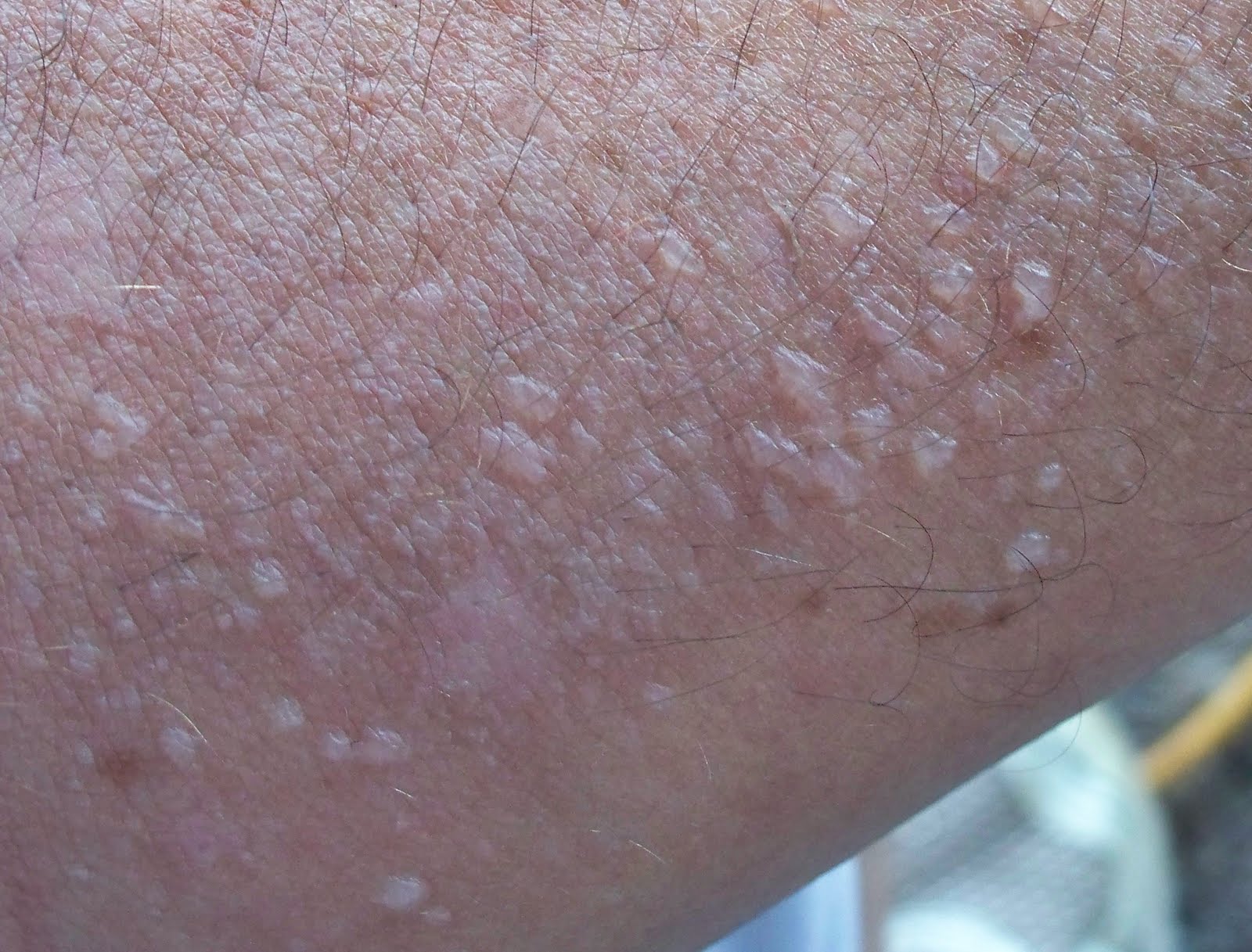 Fred Leavitt: Sweat Blisters Fred Leavitt: Sweat Blisters