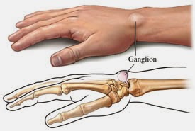 Medische Kennis: Ganglion