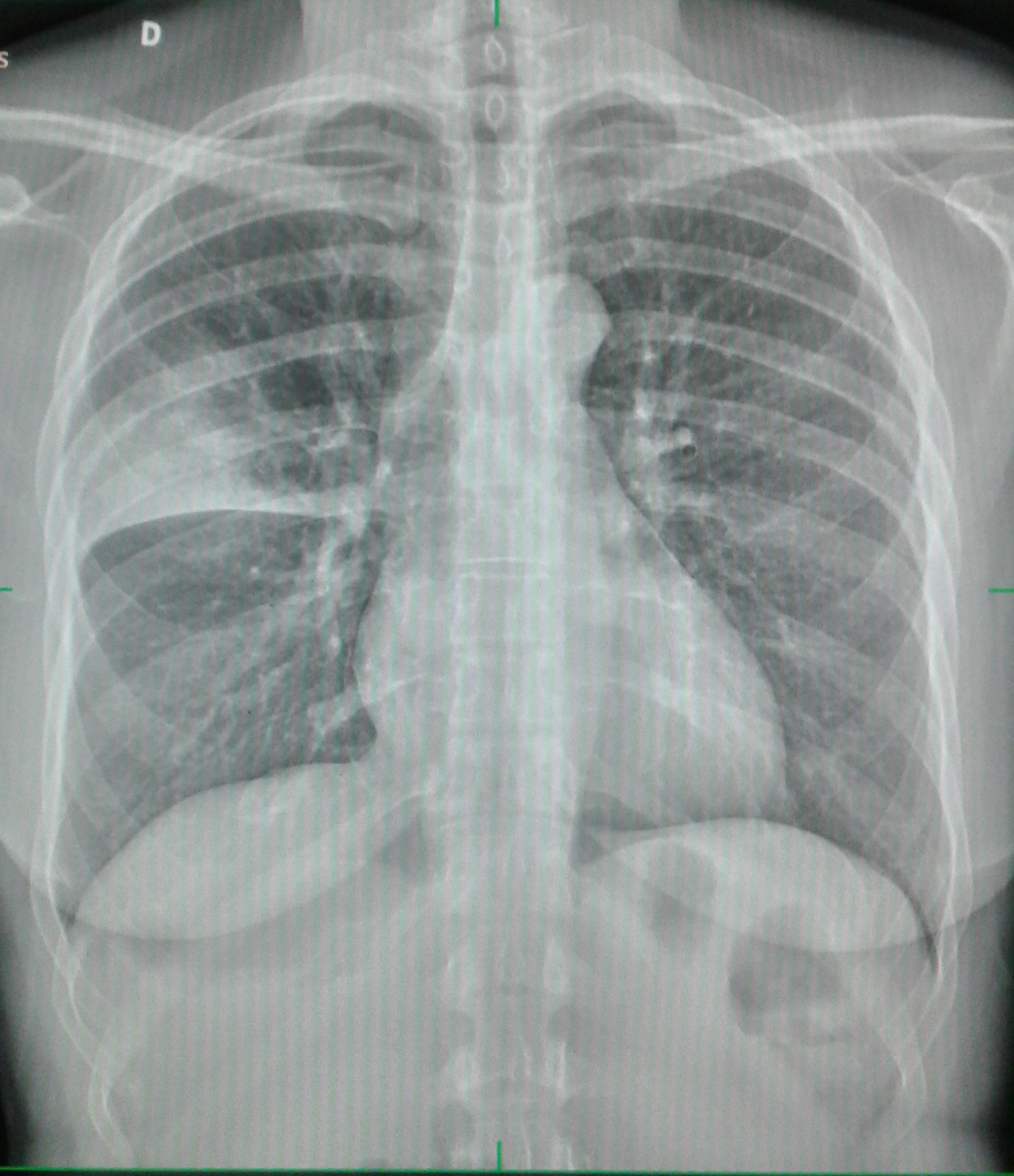 Radiografia De Torax Pa Y Lateral - Image to u Radiografia De Torax Pa Y Lateral - Image to u