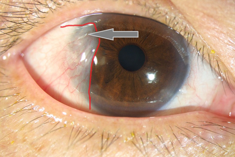 Cancer de l oeil traitement - Articles à propos de la santé