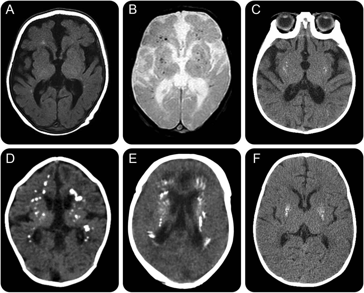 pediatric neurology: Aicardi-Goutieres syndrome