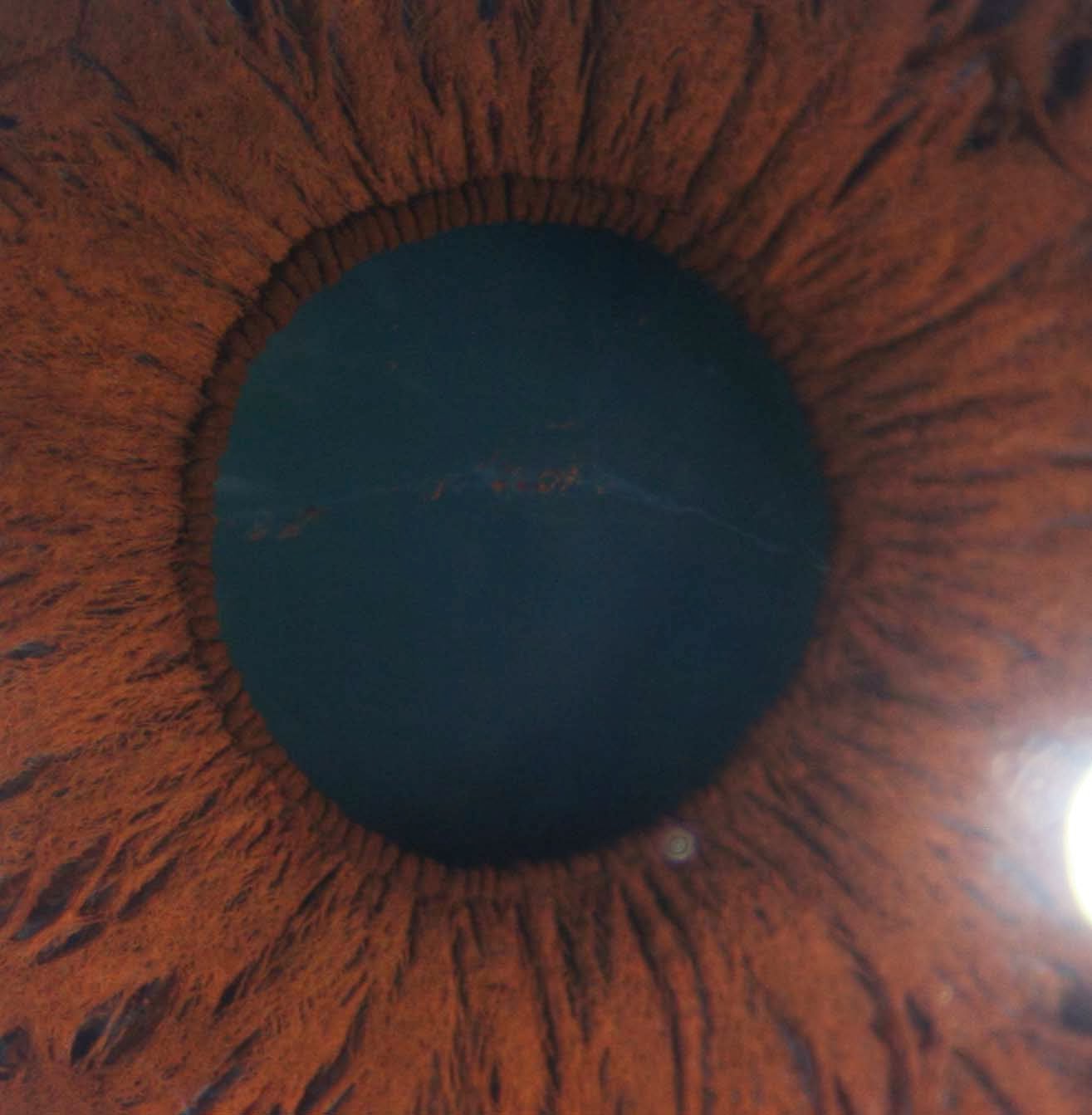 Modern & Multidimensional Iridology: IPB Morphologies, Pupil Flattening ...