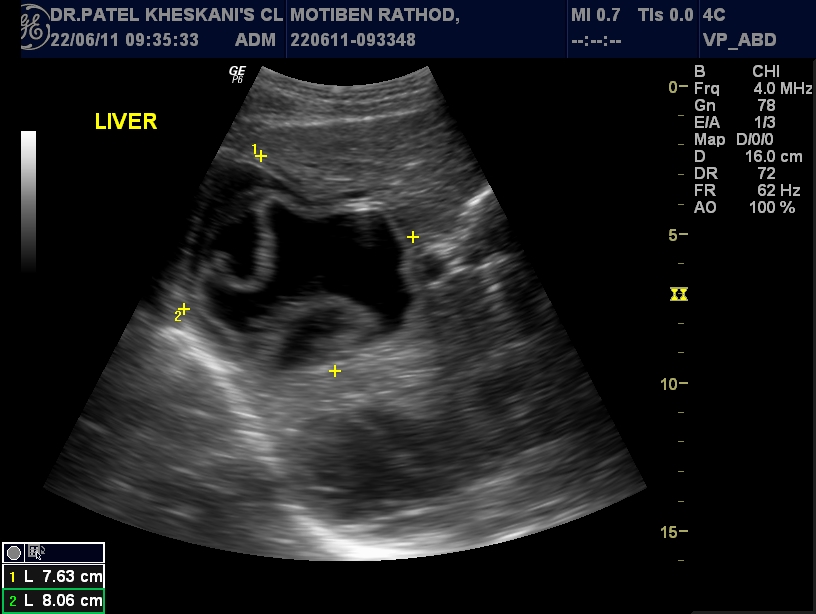 Exclusive Findings in Radiology and Imaging: Multiple Hydatid Cysts In ...