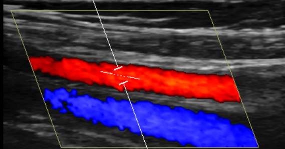 Como sobreviver ao seu médico: DOPPLER OU DOPPLERFLUXOMETRIA - O QUE É ...