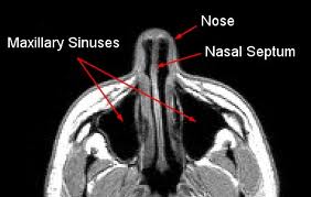 Sinusitis Understood: Imaging in the Diagnosis of Sinusitis