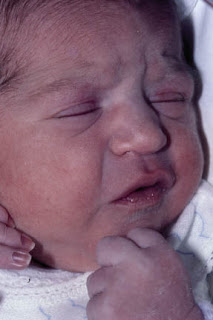 Cyanose// - Acute Zorg Blog