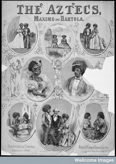 Morbid Anatomy: Dental casts of the Extraordinary Aztec Children, 1853 ...