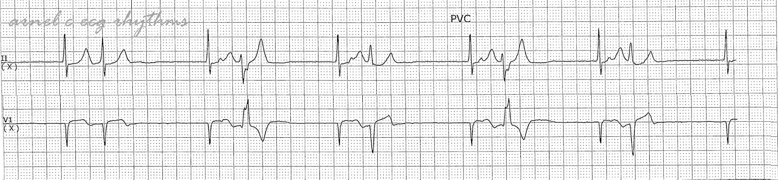 ECG Rhythms: Escape-capture Bigeminy