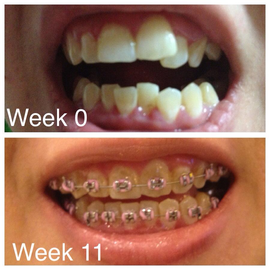 My WonderWall: Braces update! (11 Weeks)