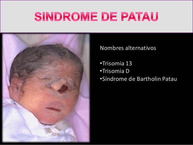 Terrible el Síndrome de Patau Blog Atendiendo Necesidades