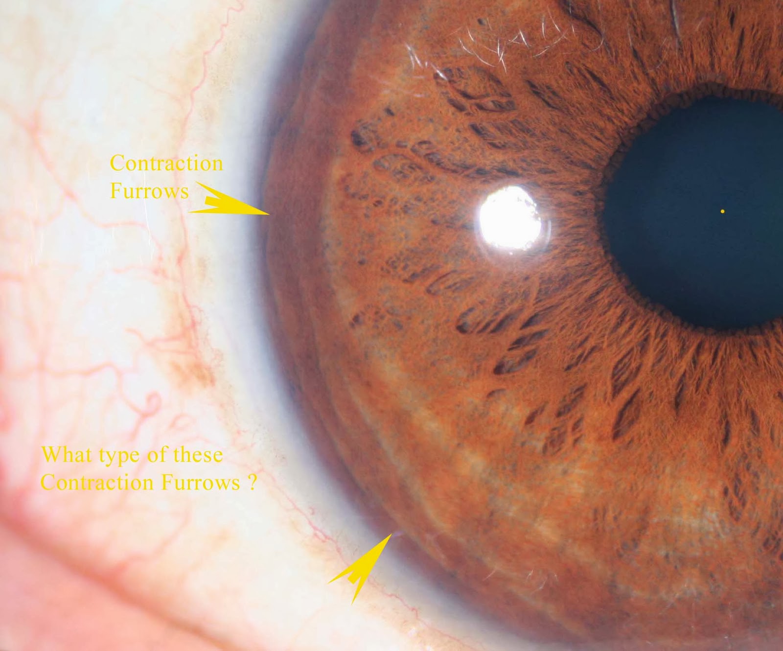Modern & Multidimensional Iridology: The Inner Pupillary Border ...