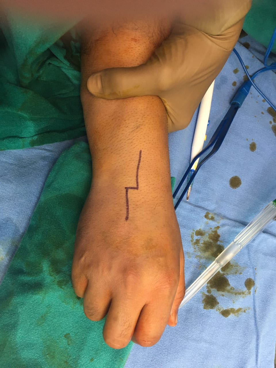 proximal row carpectomy