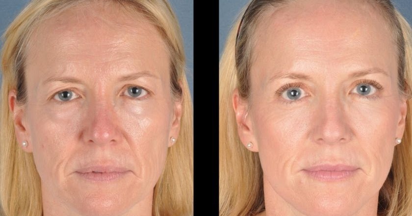 Look Younger With Facial Aerobics Exercises: Ultimate Non-Surgical ...