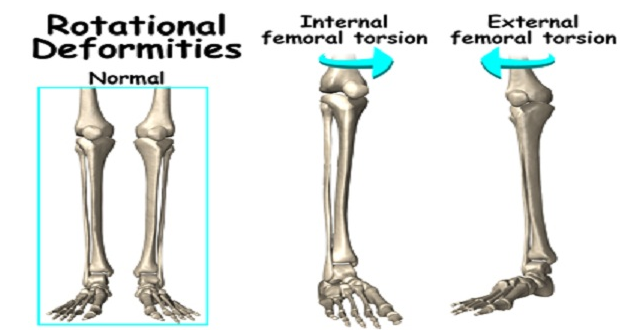 Jangan Biarkan Anak Anda Duduk Bersimpuh Katak Atau Berbentuk 'W' Begini