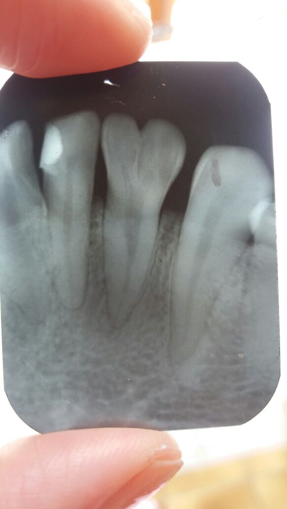rayosxmaxilofacial: Geminación Dentaria