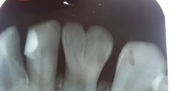 rayosxmaxilofacial: Geminación Dentaria