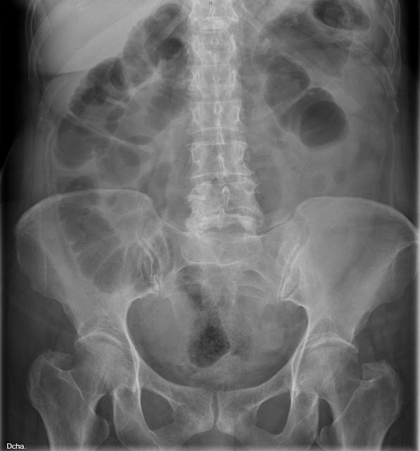 El Blog de Isa y Juan: Obstrucción intestinal por bridas