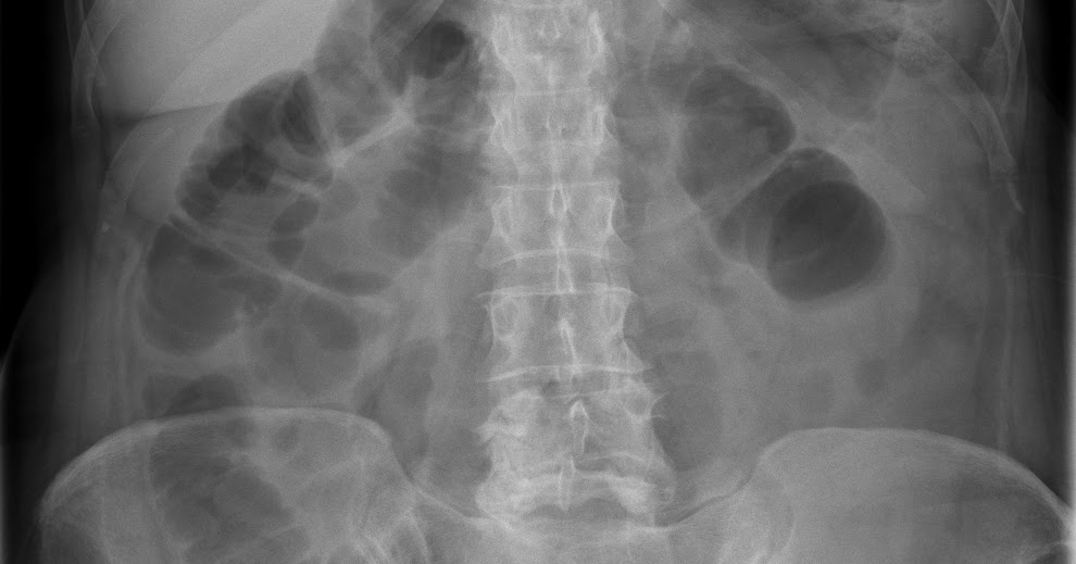 El Blog de Isa y Juan: Obstrucción intestinal por bridas