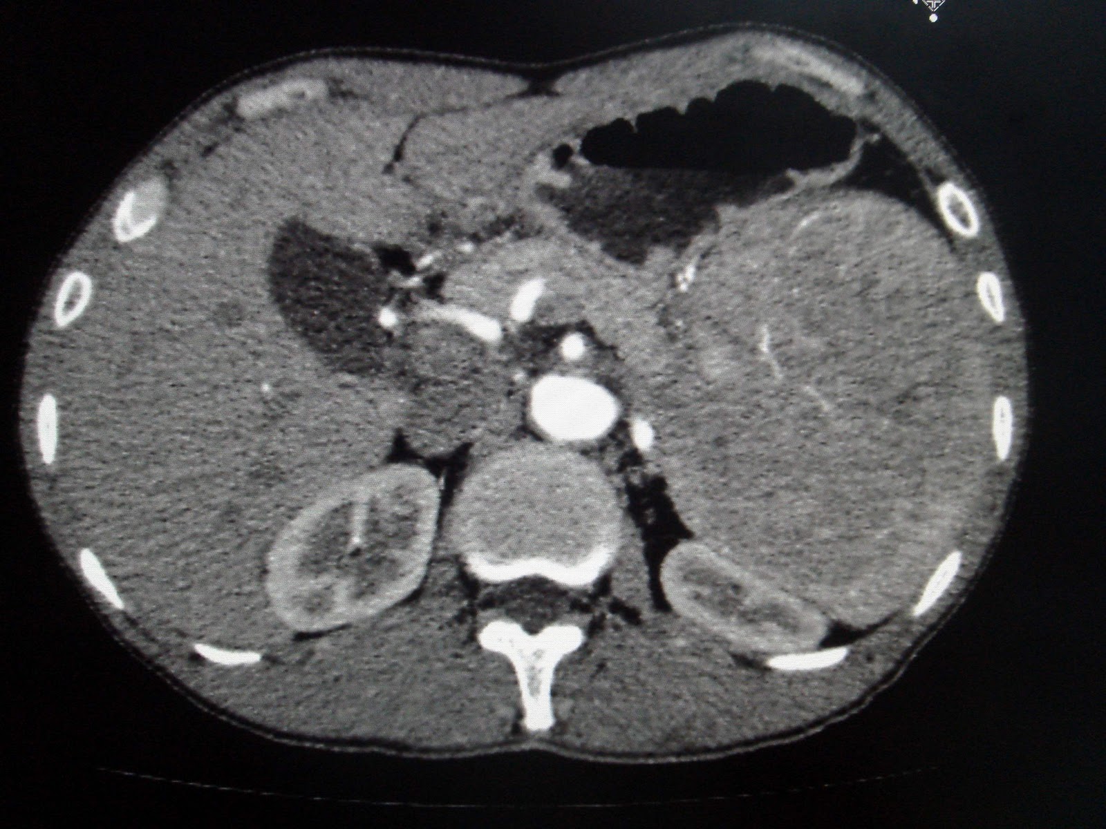 SPLEEN HAMARTOMA with THROMBOCYTOPENIA, Dr PHAN THANH HẢI, MEDIC ...