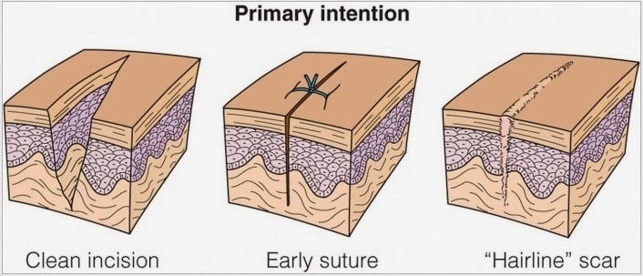 hEiDiMatEs - MeDICinE: General principle of management for open fracture