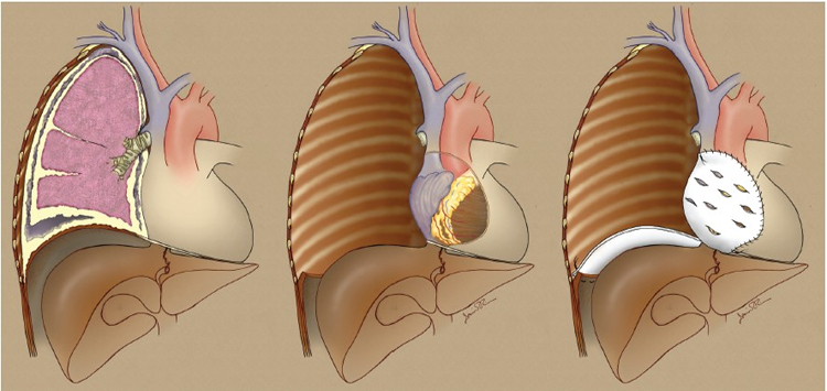 Mesothelioma Treatment - Mesothelioma Pathology Outlines