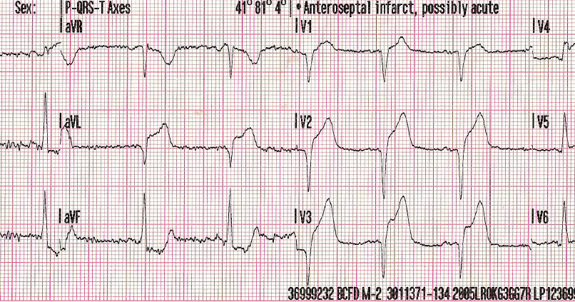 ECGs for EMS: Identification and Localization of STEMI: The ANTERIOR ...
