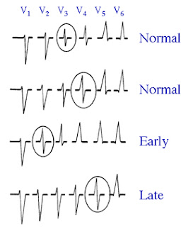 Gelombang R | INA - ECG