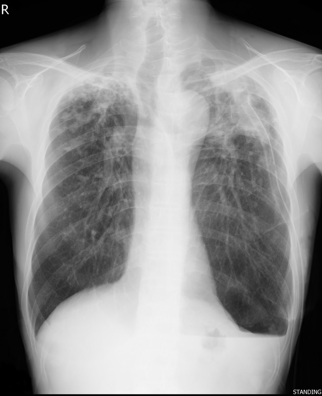 Pneumothorax in chest echo