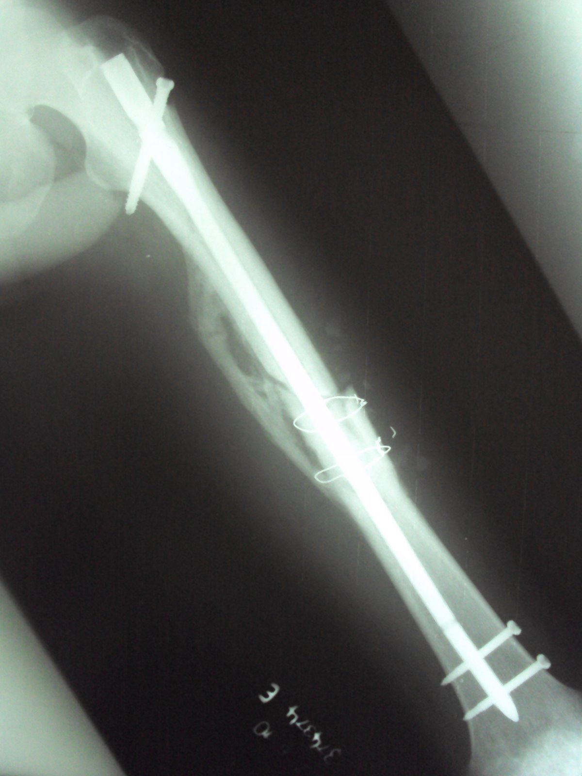 Daniel.OrtoSport: Haste intramedular em fratura diafisária de fêmur.