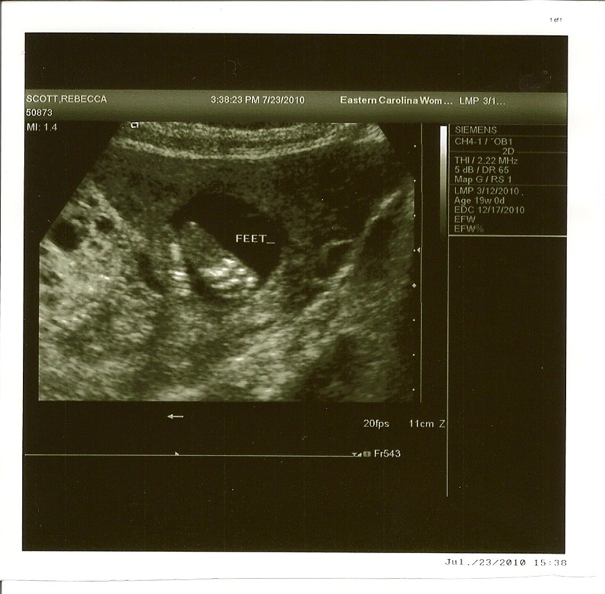 Baby Claire's Blog: Androgenetic Biparental Mosaicism, Placental ...