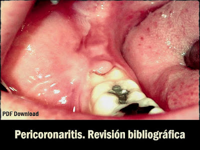 PDF: Pericoronaritis. Revisión bibliográfica - Odontología Virtual