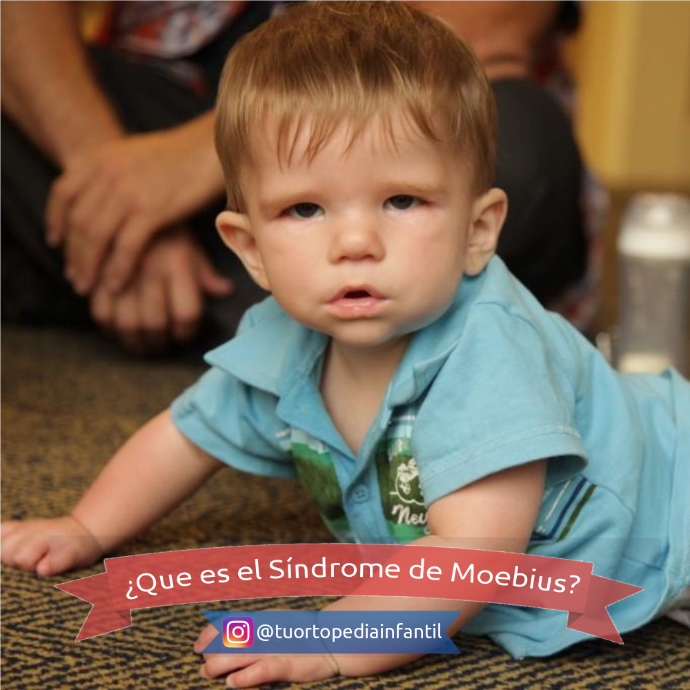 ¿Que es el Síndrome de Moebius?