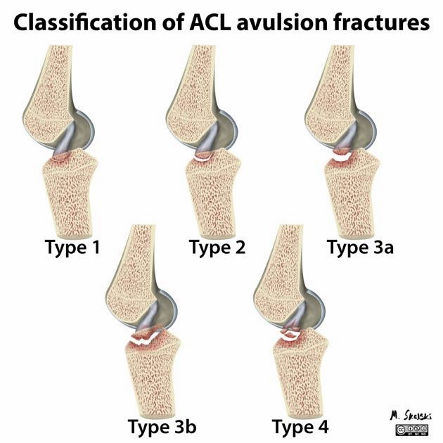Great Health: Avulsion Fracture